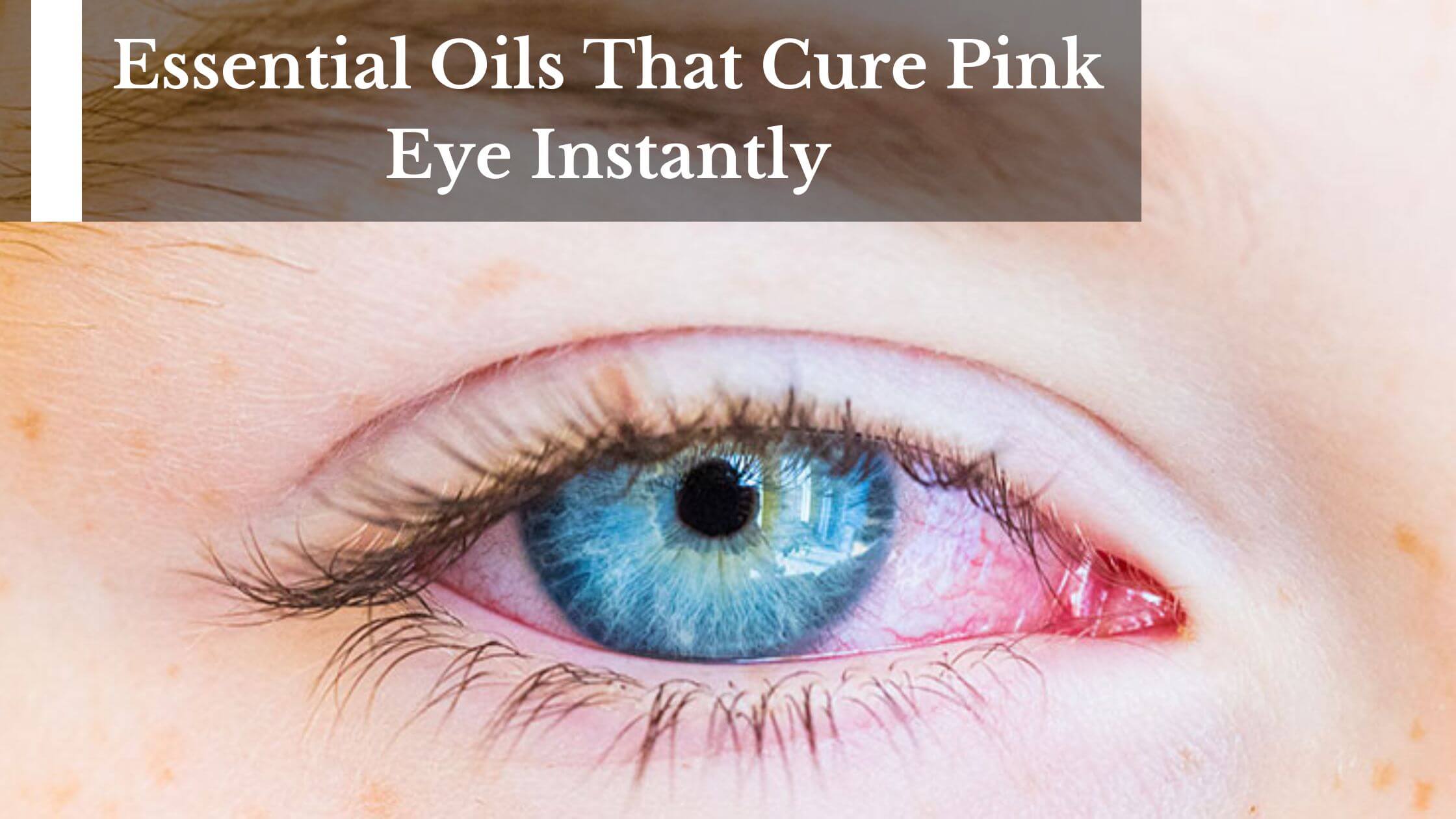 Essential Oils That Cure Pink Eye Instantly – Moksha Lifestyle Products